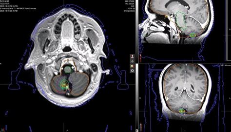Brain Metastases With Stereotactic Radiosurgery Genesiscare Uk