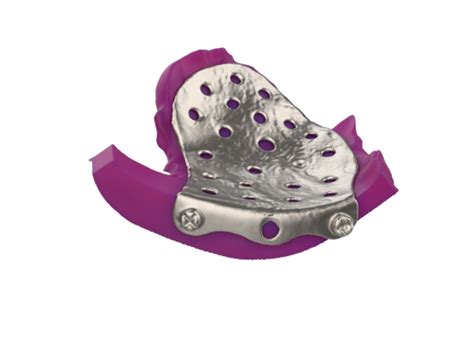 Queen Elizabeth Hospital Maxillectomy Using Freeform Software Or3d