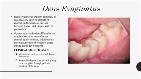 Developmental Disturbances Of Teeth Pptx