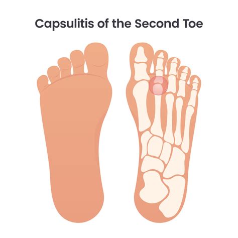 Toe Joint Pain Capsulitis At Jasmine Disher Blog