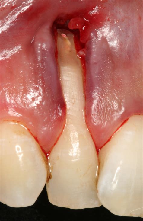 A Clean Root Surface Can Be Observed After Scaling Planing And Download Scientific Diagram