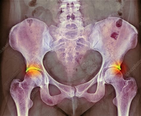 Femoroacetabular Impingement X Ray Stock Image C0614734 Science