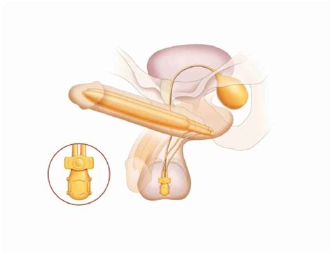 Best Penile Implants In India Penile Prosthesis Surgery Dr Nitesh