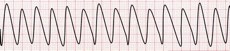 Polymorphic Ventricular Tachycardia Vs Ventricular Fibrillation
