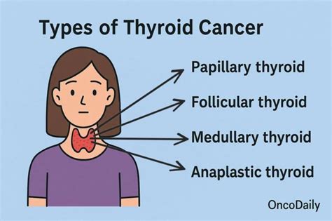 Thyroid Cancer Symptoms Causes Stages Diagnosis And Treatment Oncodaily