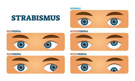 Clinical Types Of Ocular Deviation Optography