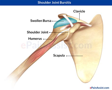 Shoulder Joint Bursitiscausessymptomstreatment Conservative Pt Surgery