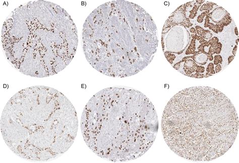 P63 Expression In Cancerous Tissues Strong P63 Immunostaining Is Seen