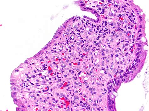 Pathology Outlines Case Of The Month 527