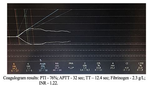 Study Of Key Aspects Of Anticoagulant And Antiplatelet Therapies New