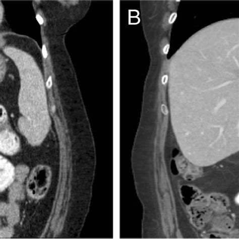 Ectopic Tumor Related Hepatic Calcification In A Patient With