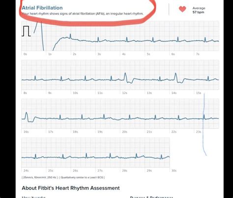 Is This Afib Rpvcs