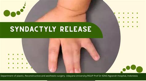 Syndactyly Release Pptx
