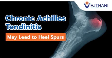 Achilles Spur The Lateral Radiograph Of The Foot Shows The Presence Of