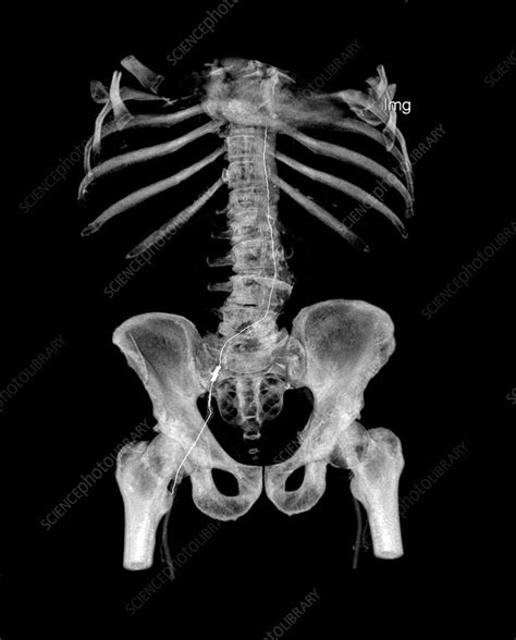 3d Skeletal Reconstruction Stock Image M2600387 Science Photo