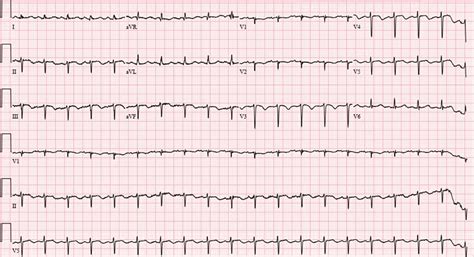 Electrocardiogram Ecg On Admission Showing Left Axis Deviation Sinus