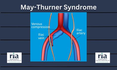 Understanding May Thurner Syndrome Interventional Radiology Located In Denver And Northern