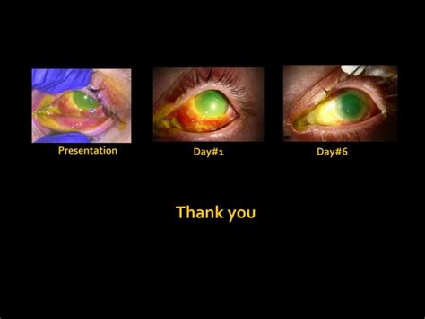 Ocular Chemical Burns Pathophysiology And Evidence Based Treatment Pptx
