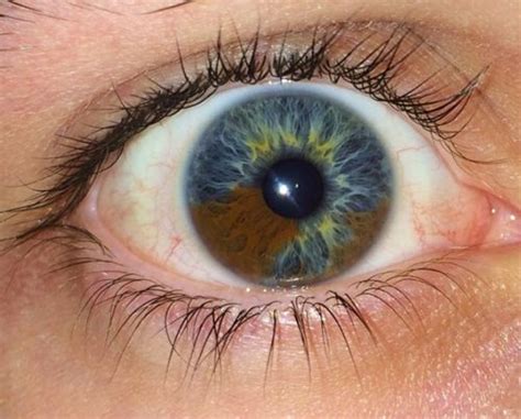 Sectoral Heterochromia Sectoral Heterochromia Heterochromia Pretty Eyes