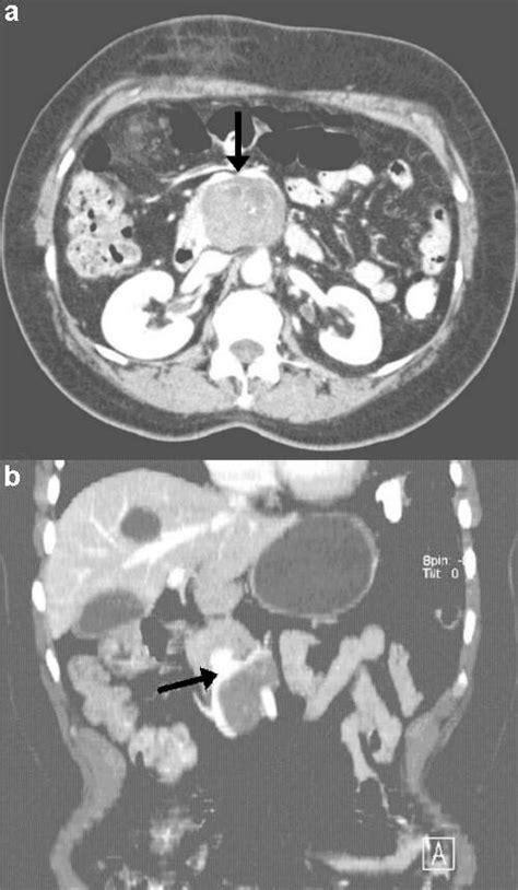 Delayed Phase Ct Scan A With 3 D Reconstruction B Demonstrated