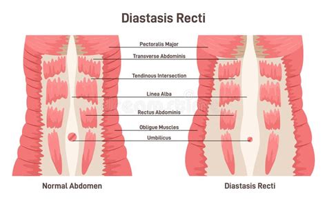 Diastasis Recto Separación De Músculos Abdominales Músculos Del Torso