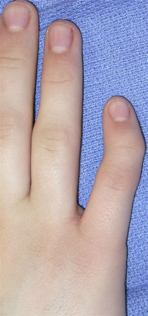 Congenital Hand Differences Journal Of Hand Surgery