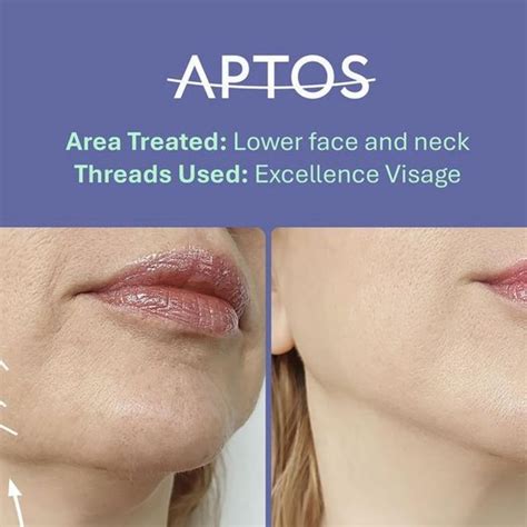 Dr Buddy Paul Beaini On Instagram Aptos Non Pdo Thread Facelift