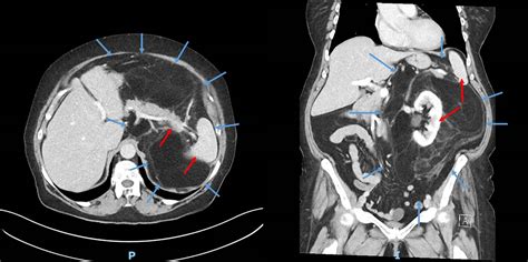 Retroperitoneal And Mesenteric Liposarcomas Surgical Oncology Clinics