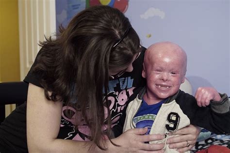 Harlequin Ichthyosis Rare Condition Causes Five Year Olds Skin To At
