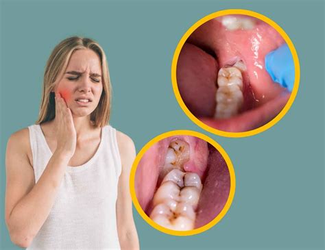 Lower Impacted Wisdom Teeth