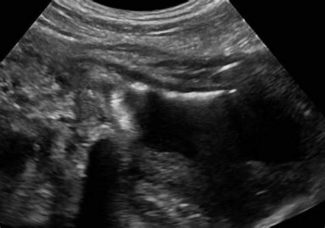 Abdomen And Retroperitoneum 1 5 Appendix Case 1 5 3 Complicated Appendicitis Ultrasound Cases