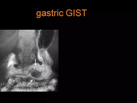 44 Dr Ahmed Esawy Imaging Oral Board Of Bowel Imaging Part Ii Stomach