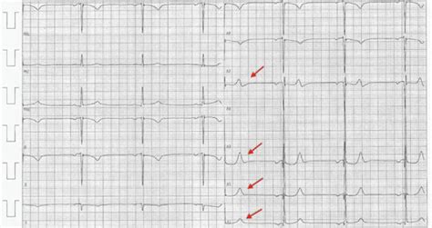 The Ecg Above Shows A Typical Juvenil Pattern With T Wave Inversion Download Scientific