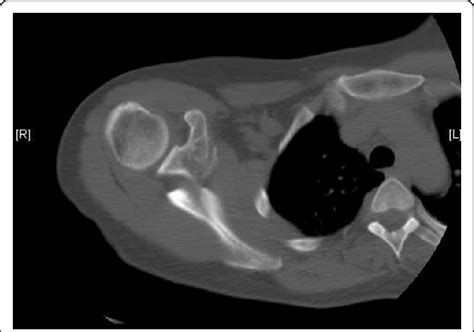 Ct Scan Showing The Metastatic Lesion At The Base Of The Coracoid