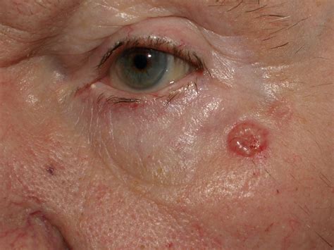 Histologynodular Basal Cell Carcinoma Low Power