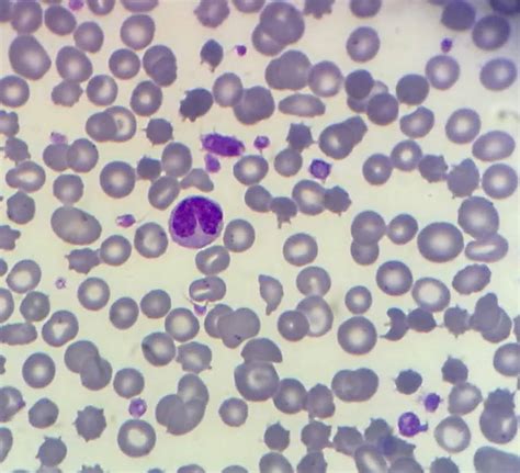 Macro Platelets Medical Laboratories