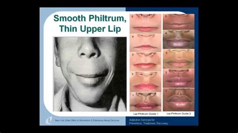 Soft Maxx Your Philtrum Elements Of Morphology Human Malformation