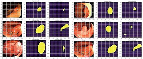 Semantic Segmentation For Predicted Polyps Of Mixed Dataset Download