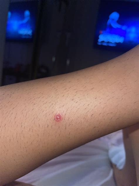 Not Ringworm… So What Is It R Diagnoseme