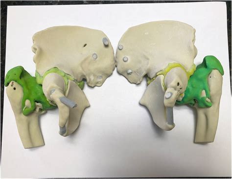 Spondyloepiphyseal Dysplasia Congenita Use Of Complementary 3d