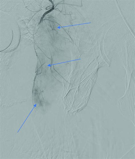 Groin Spindle Cell Sarcoma Applied Radiology