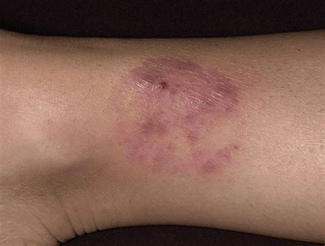 Imagebody Ringworm Tinea Corporis Merck Manual Consumer Version