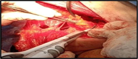 Axillary Dissection Using Harmonic Focus Download Scientific Diagram