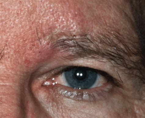 Dermatofibrosarcoma Protuberans Ento Key