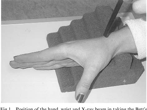 Figure 1 From Radiographic Optimization Of The Eaton Classification