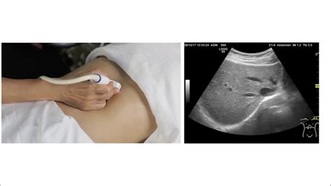 How To Read Ultrasound Of Abdomen At Holly Brough Blog