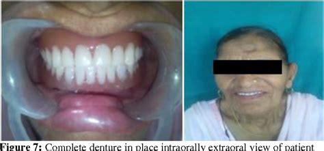 Figure 1 From Management Of Severely Resorbed Mandibular Ridge With