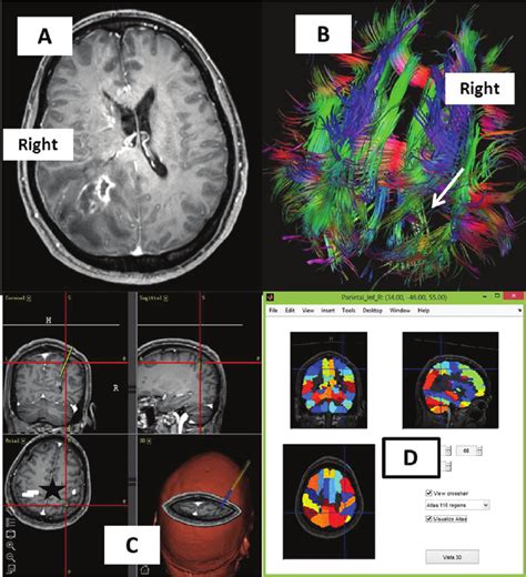 Site And Surgical Approach A A Lesion At Right Periatrial Region