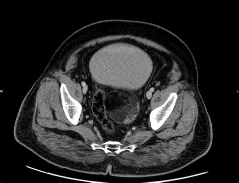 Radiopaedia Case Pelvic Dermoid Cyst In A Male Patient Id 58152 Study