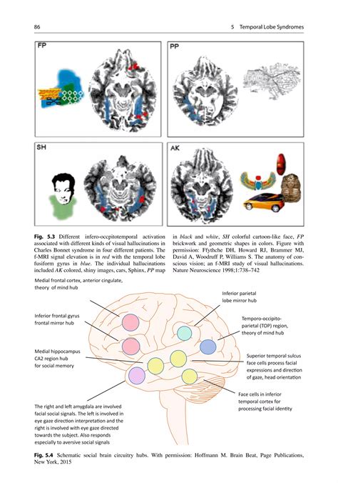 Temporal Lobe Syndromepdf Brain And Nervous System Disorders Diseases And Conditions